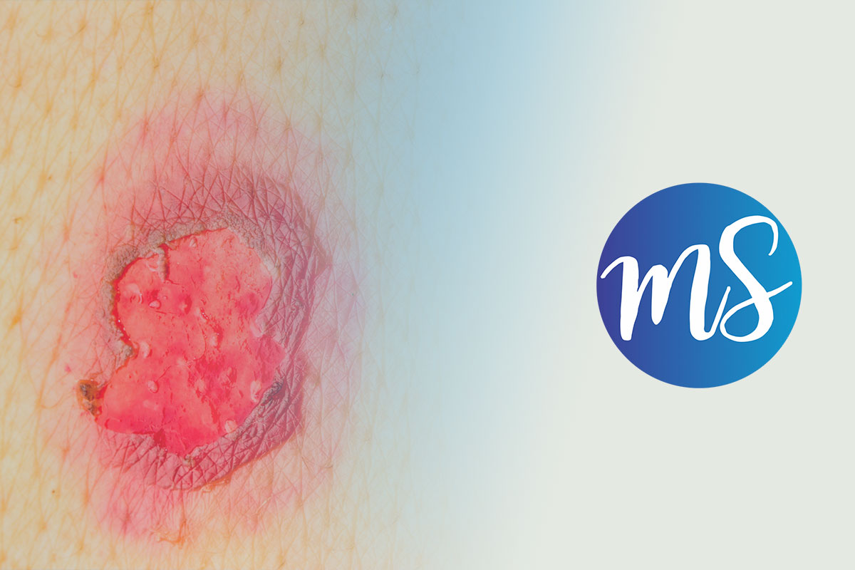 Somos Especialistas no Tratamento de Queimaduras